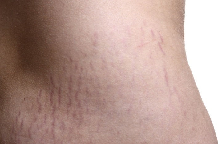 Por qué salen las estrías rojas? - La Tía Verde